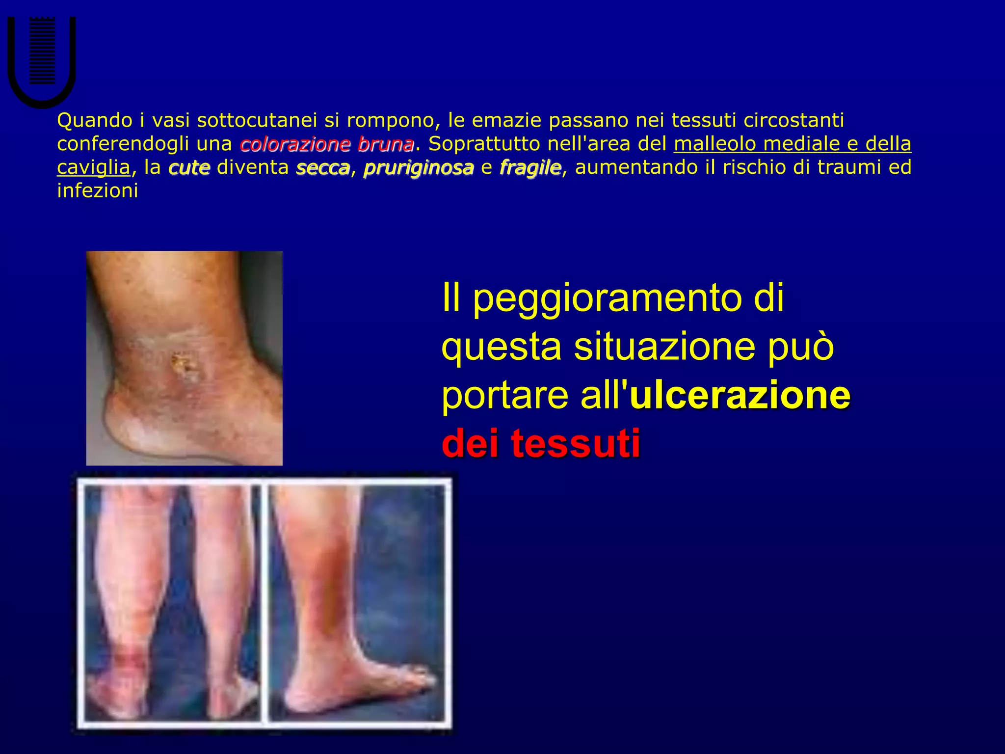 TROMBOSI VENOSA PROFONDA TVP LEZIONE MEDICINA INTERNA ROBERTO LEO 2019 ...