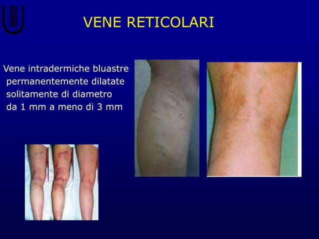 TROMBOSI VENOSA PROFONDA TVP LEZIONE MEDICINA INTERNA ROBERTO LEO 2019 ...