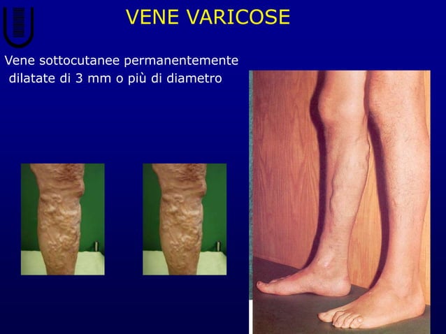 TROMBOSI VENOSA PROFONDA TVP LEZIONE MEDICINA INTERNA ROBERTO LEO 2019 ...