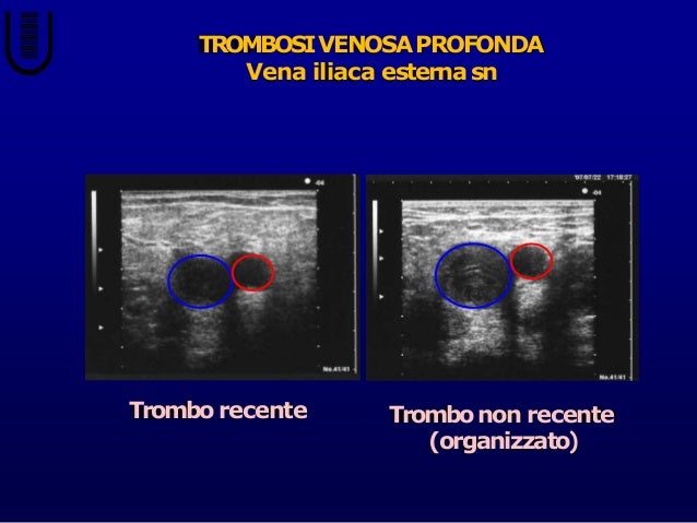 TROMBOSI VENOSA PROFONDA TVP LEZIONE MEDICINA INTERNA ROBERTO LEO 2019