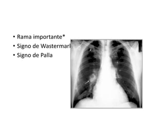 TROMBOSIS VENOSA PROFUNDA Y TROMBOEMBOLIA PULMONAR | PPTX