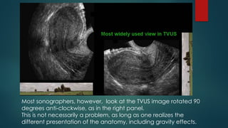 TVS howto do lesionsin tvs findings of LESIONS | PPTX