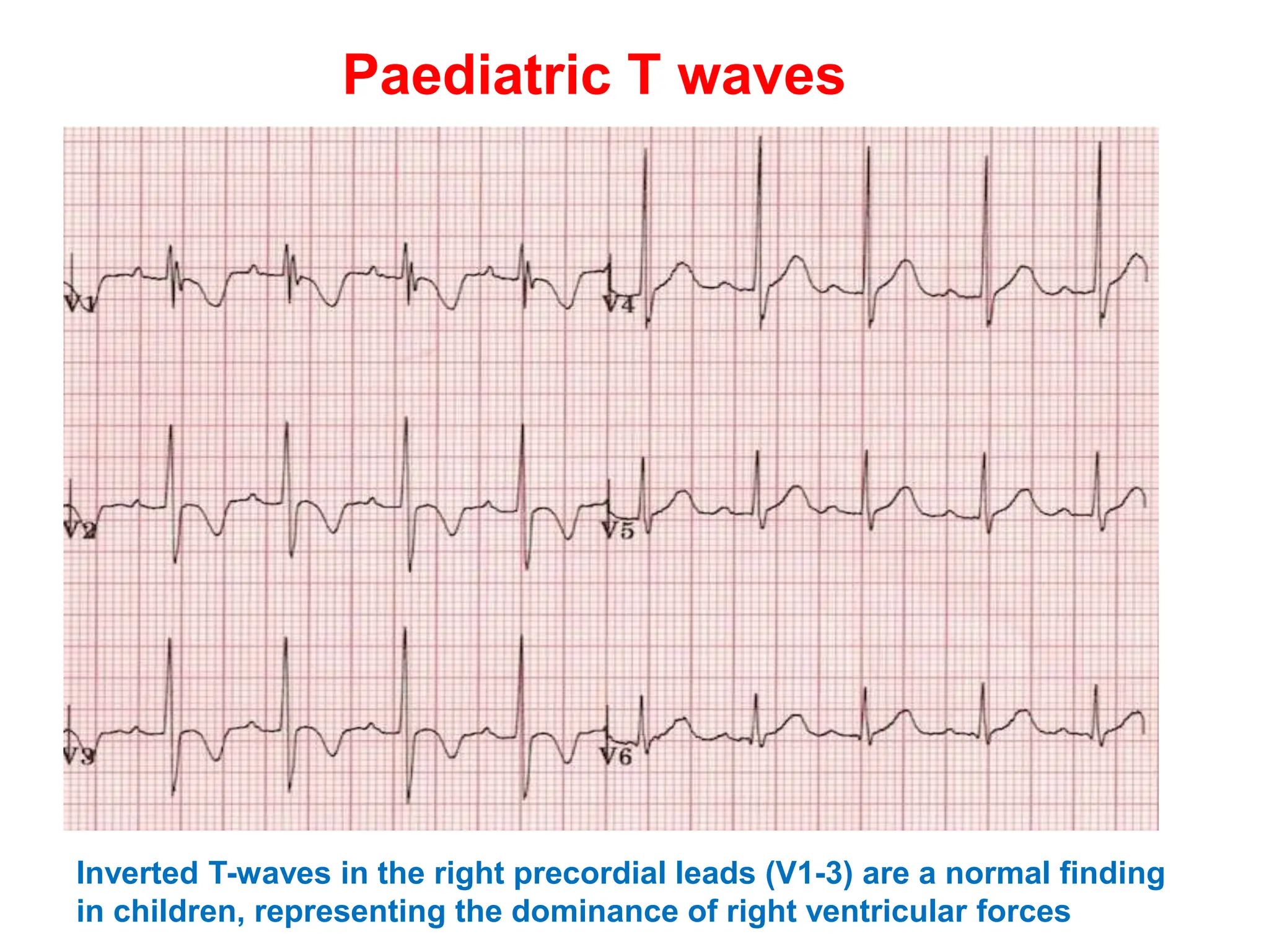 T WAVE IN ECG AND ITS ABNORMALITIES IN ECG | PPTX