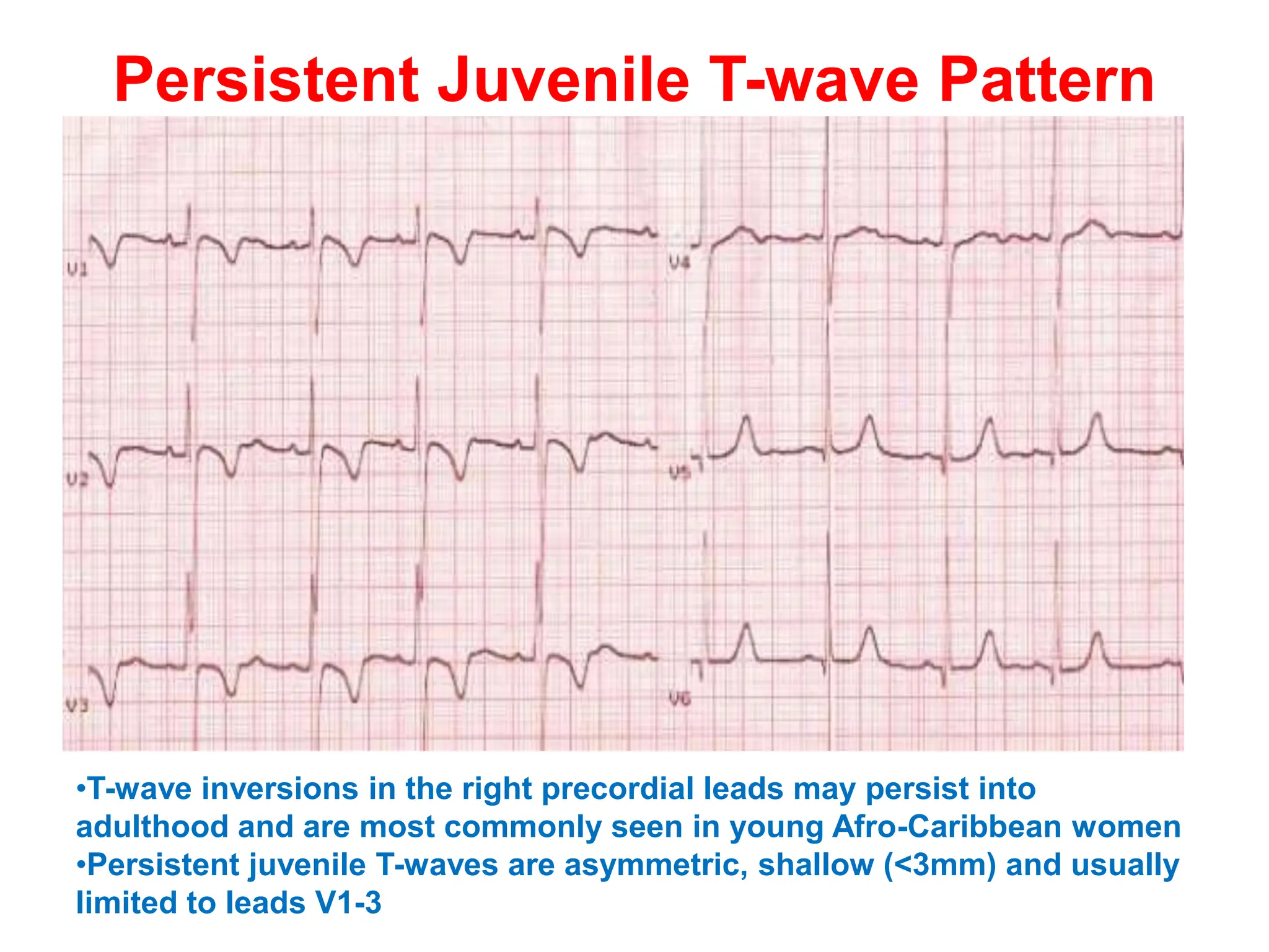 T WAVE IN ECG AND ITS ABNORMALITIES IN ECG | PPTX