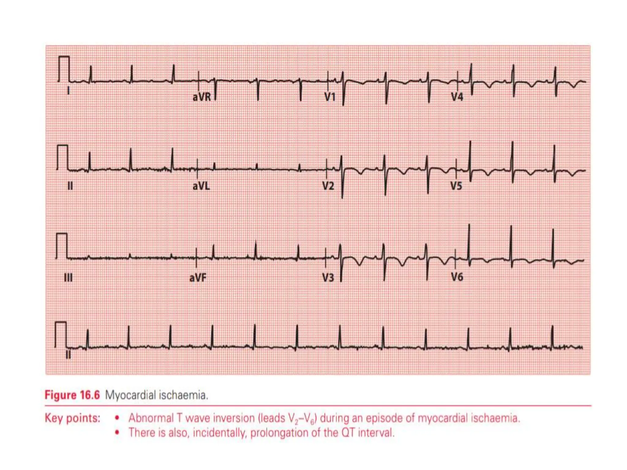 T WAVE IN ECG AND ITS ABNORMALITIES IN ECG | PPTX