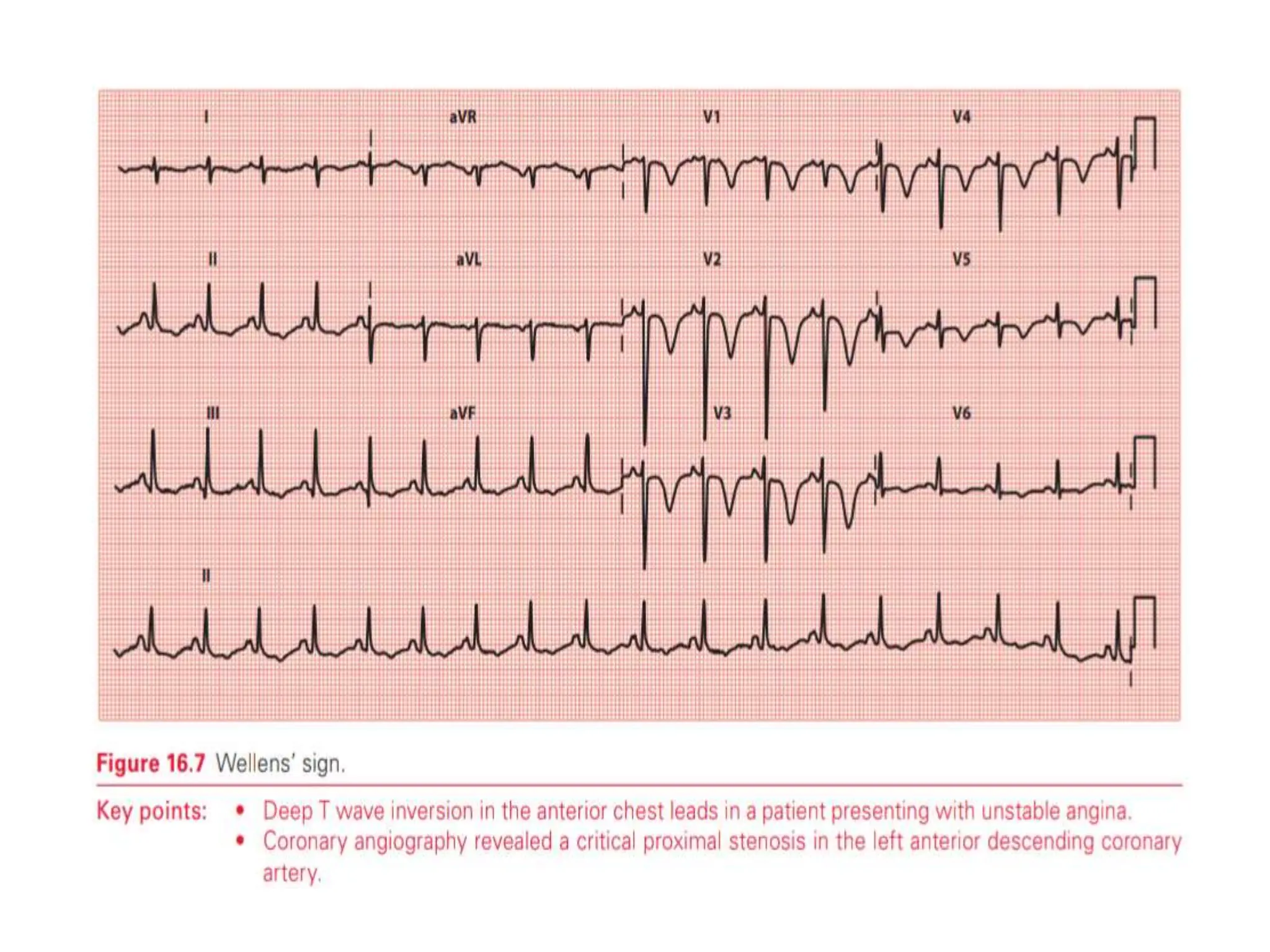 T WAVE IN ECG AND ITS ABNORMALITIES IN ECG | PPTX