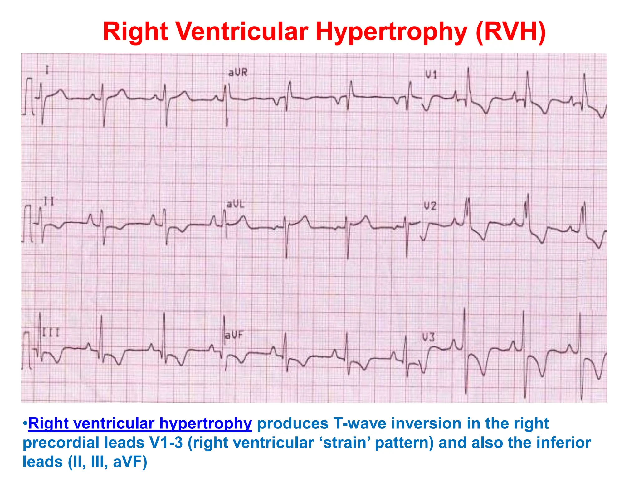 T WAVE IN ECG AND ITS ABNORMALITIES IN ECG | PPTX