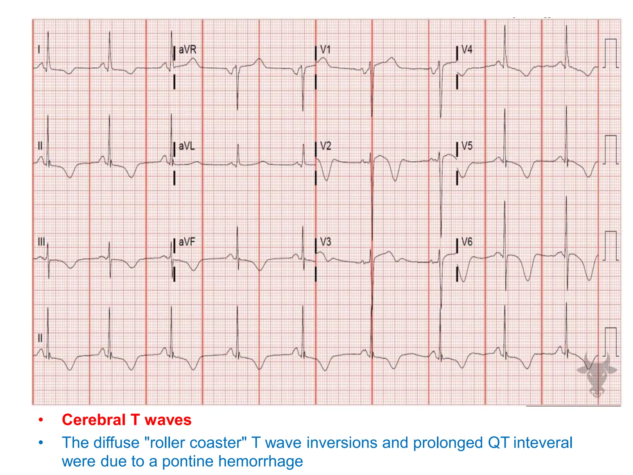 T WAVE IN ECG AND ITS ABNORMALITIES IN ECG | PPTX