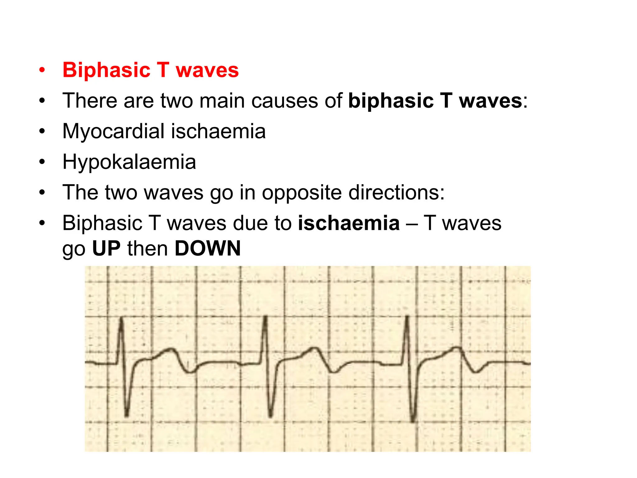 T WAVE IN ECG AND ITS ABNORMALITIES IN ECG | PPTX