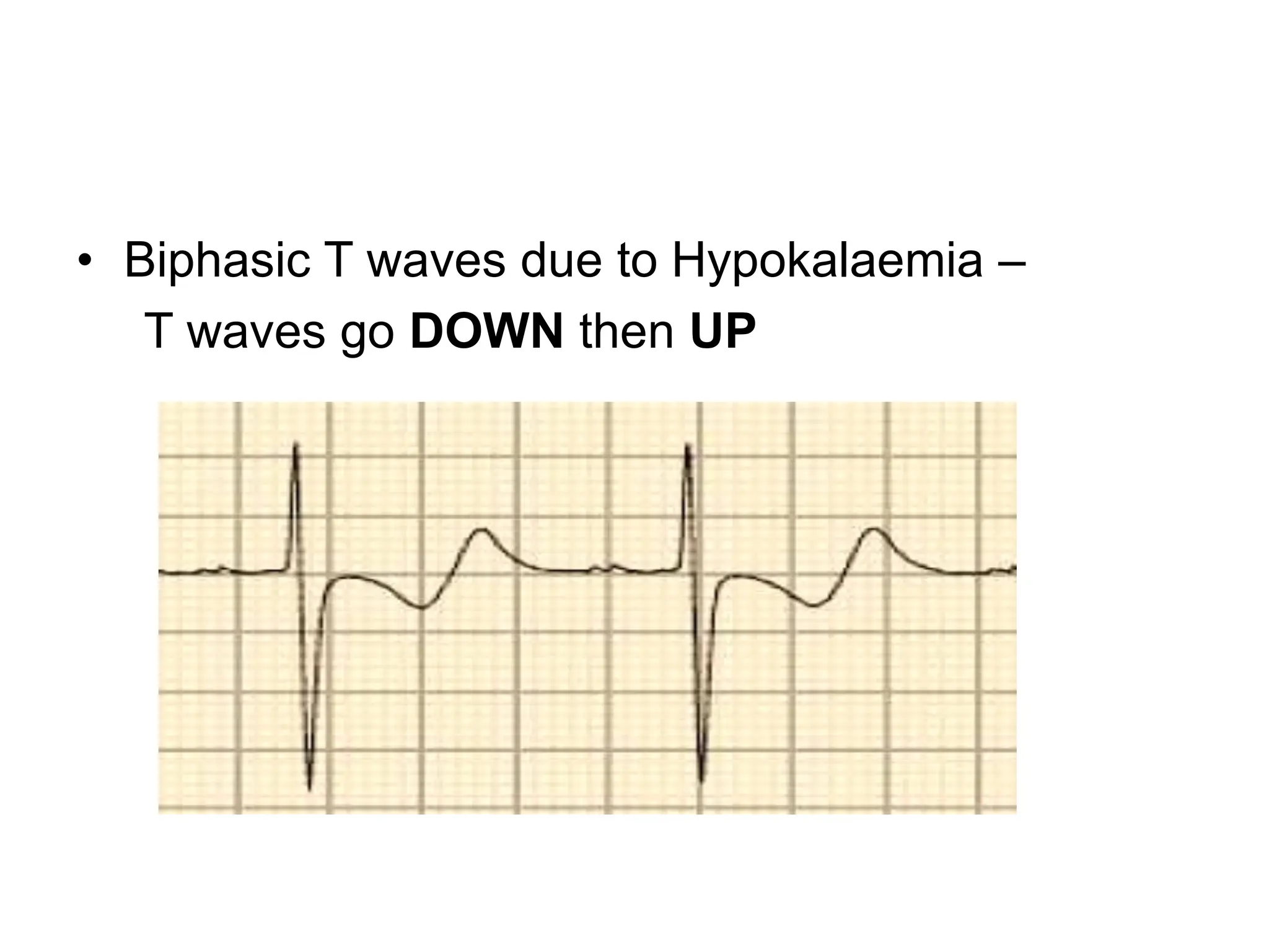 T WAVE IN ECG AND ITS ABNORMALITIES IN ECG | PPTX