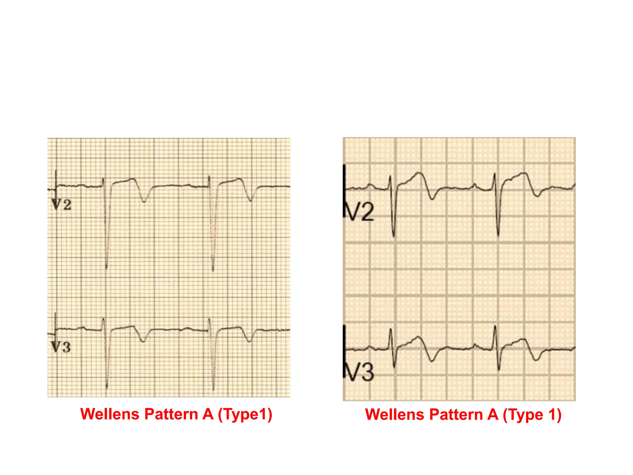 T WAVE IN ECG AND ITS ABNORMALITIES IN ECG | PPTX