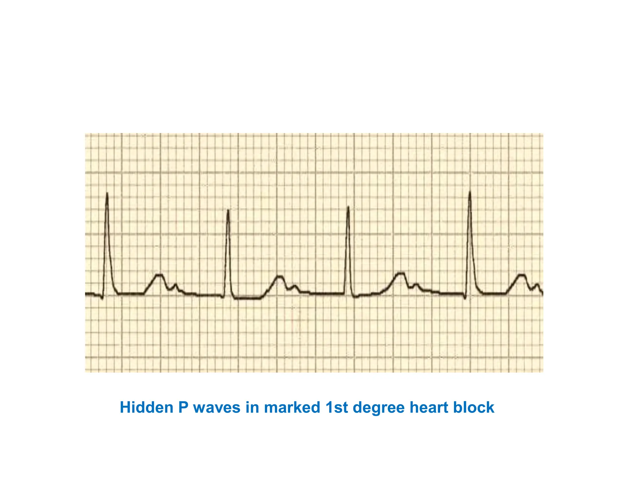 T WAVE IN ECG AND ITS ABNORMALITIES IN ECG | PPTX