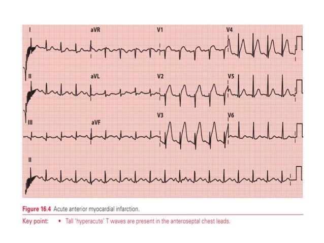 T WAVE IN ECG AND ITS ABNORMALITIES IN ECG | PPTX