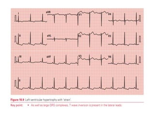 T WAVE IN ECG AND ITS ABNORMALITIES IN ECG | PPTX