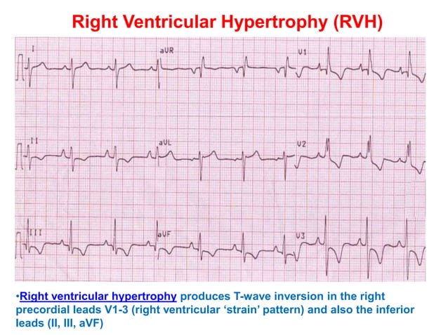 T WAVE IN ECG AND ITS ABNORMALITIES IN ECG | PPTX