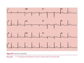 T WAVE IN ECG AND ITS ABNORMALITIES IN ECG | PPTX