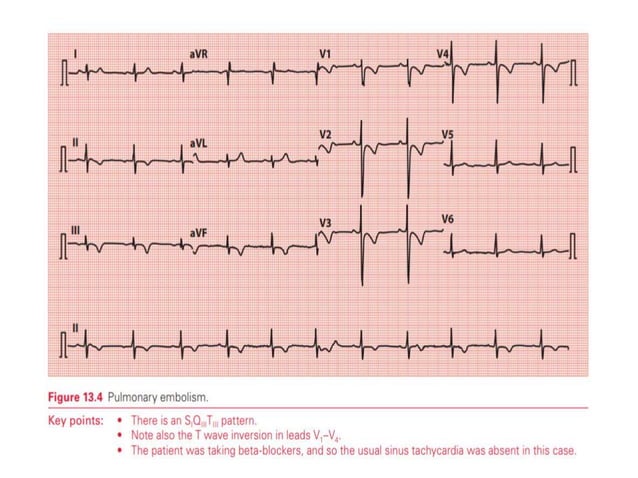 T WAVE IN ECG AND ITS ABNORMALITIES IN ECG | PPT