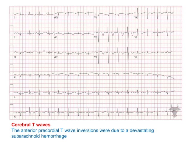 T WAVE IN ECG AND ITS ABNORMALITIES IN ECG | PPTX
