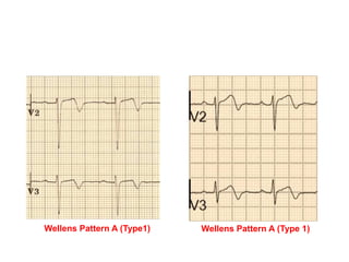 T WAVE IN ECG AND ITS ABNORMALITIES IN ECG | PPTX