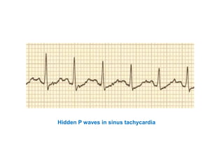 T WAVE IN ECG AND ITS ABNORMALITIES IN ECG | PPTX
