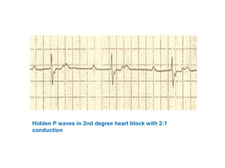 T WAVE IN ECG AND ITS ABNORMALITIES IN ECG | PPTX