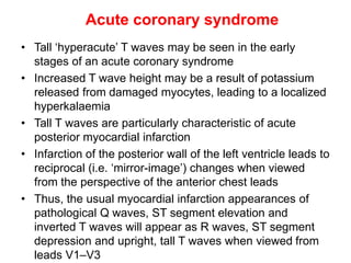T WAVE IN ECG AND ITS ABNORMALITIES IN ECG | PPTX