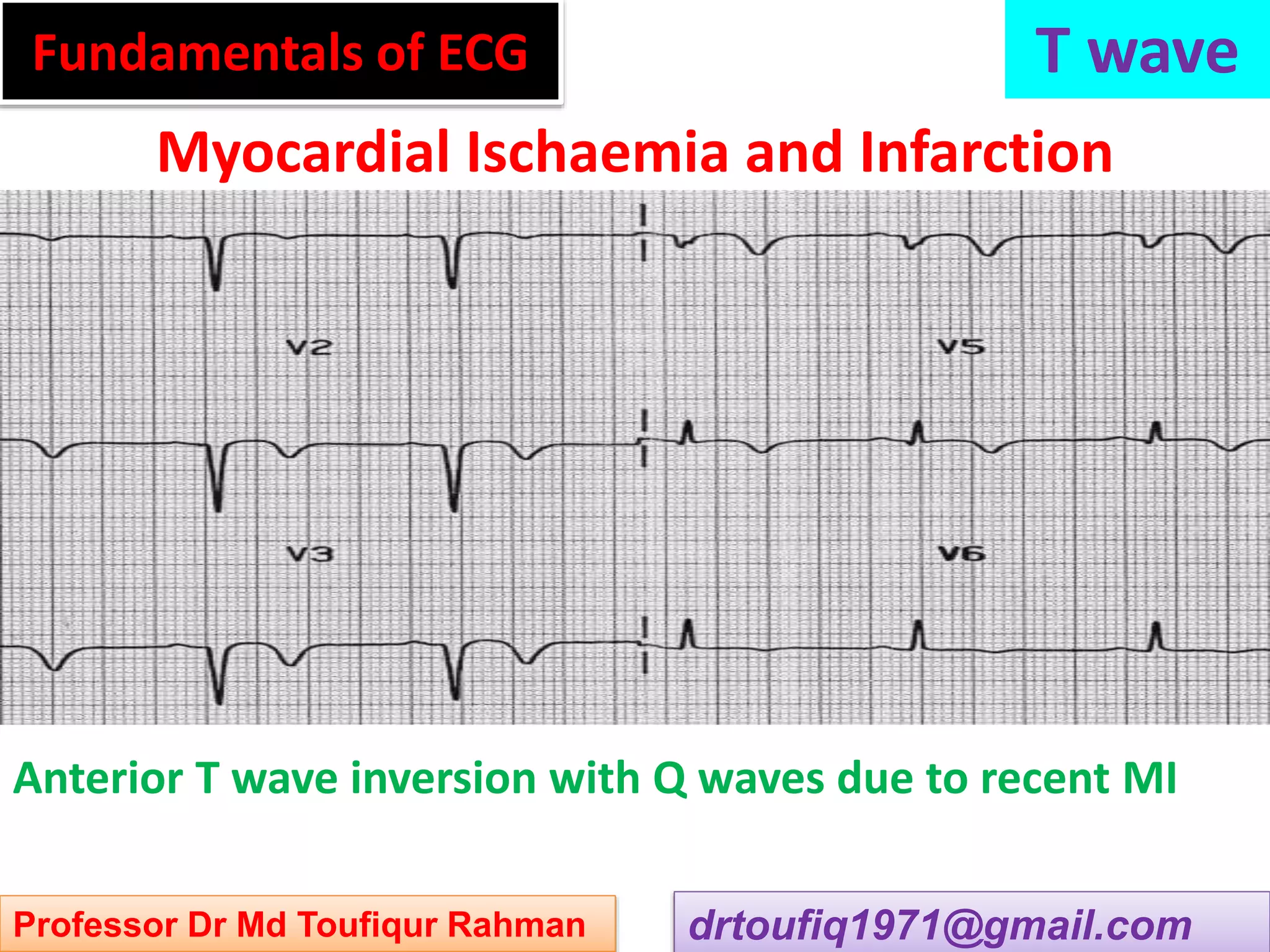 Approach to a patient with T wave abnormality in ECG | PPSX