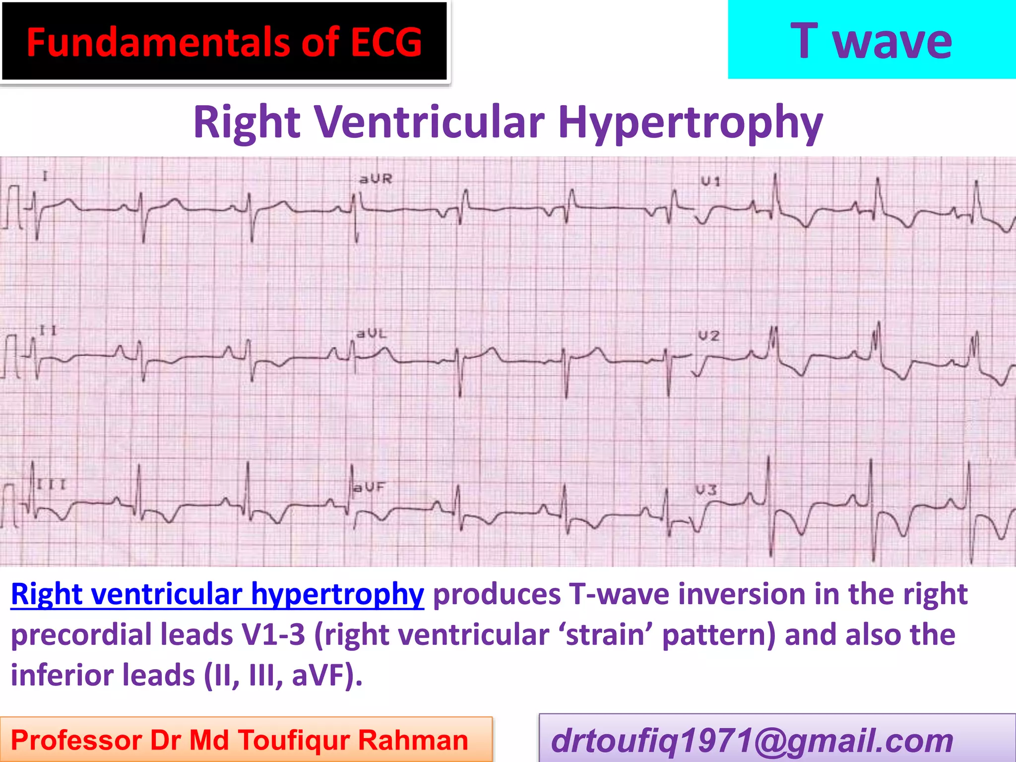 Approach to a patient with T wave abnormality in ECG | PPSX