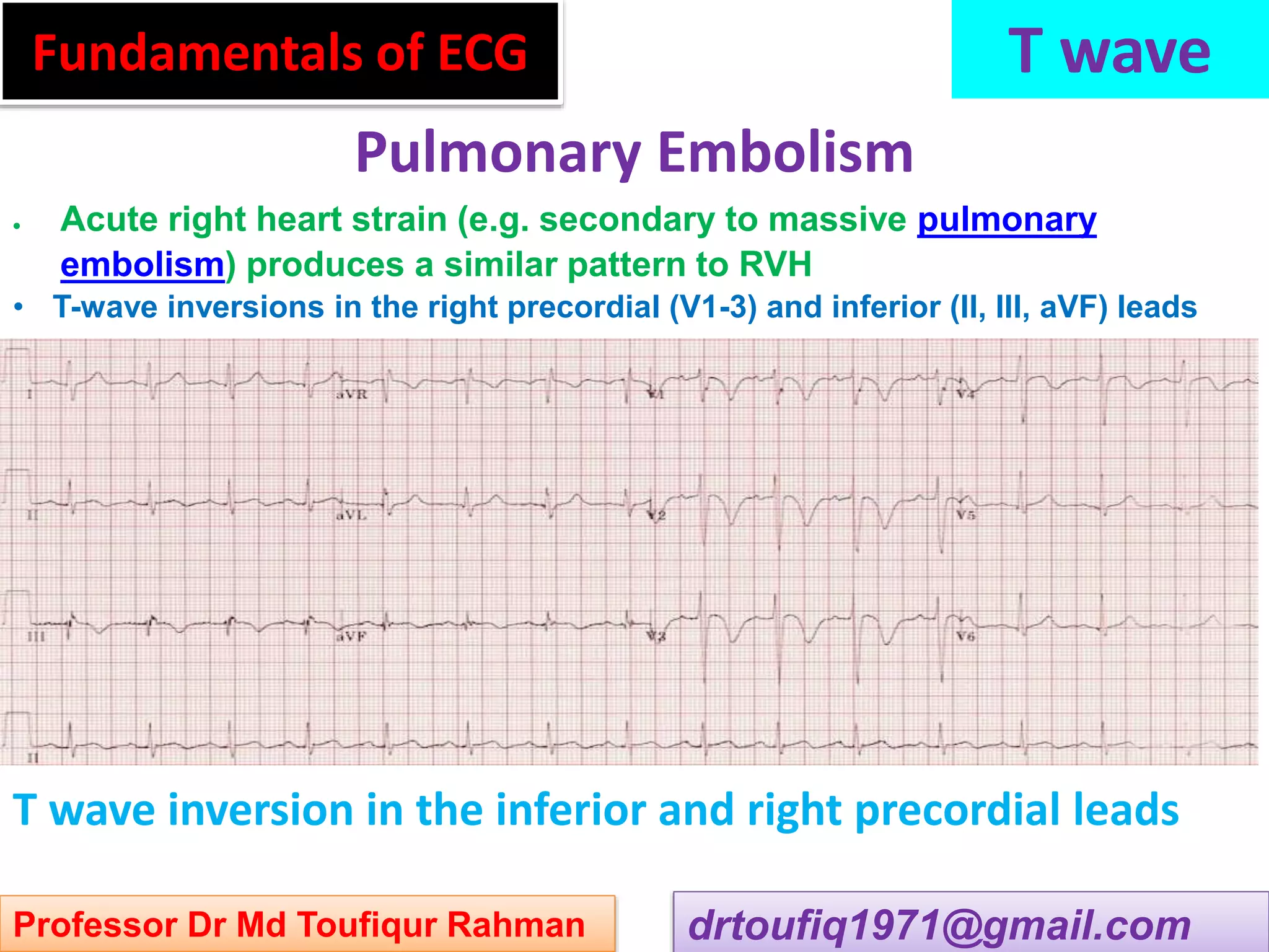 Approach to a patient with T wave abnormality in ECG | PPSX | Heart and ...