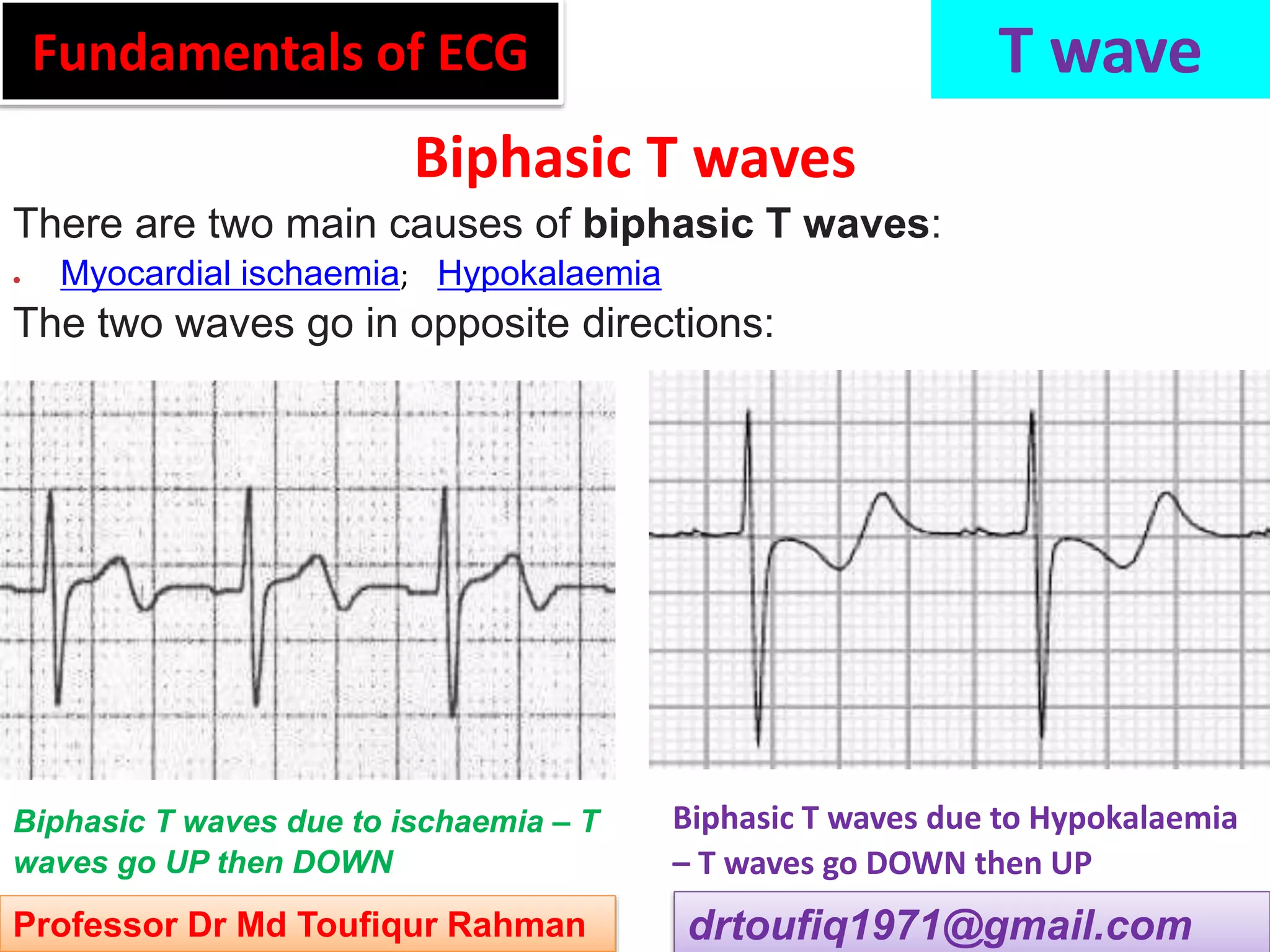 Approach To A Patient With T Wave Abnormality In Ecg Ppsx Heart And Cardiovascular Diseases