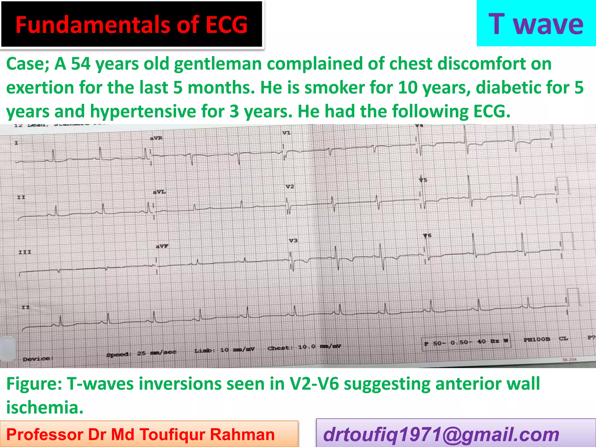 Approach to a patient with T wave abnormality in ECG | PPSX