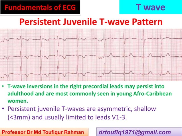 Approach to a patient with T wave abnormality in ECG | PPSX | Heart and ...
