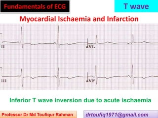 Approach to a patient with T wave abnormality in ECG | PPSX