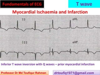 Approach to a patient with T wave abnormality in ECG | PPSX