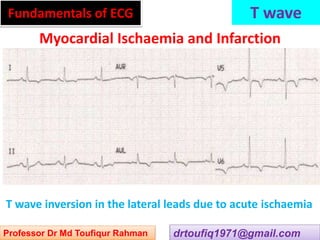 Approach to a patient with T wave abnormality in ECG | PPSX