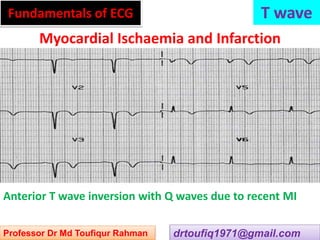 Approach to a patient with T wave abnormality in ECG | PPSX