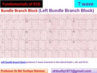 Approach to a patient with T wave abnormality in ECG | PPSX