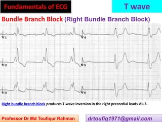 Approach to a patient with T wave abnormality in ECG | PPSX