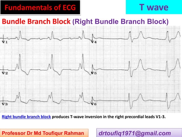 Approach to a patient with T wave abnormality in ECG | PPSX | Heart and ...