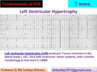 Approach to a patient with T wave abnormality in ECG | PPSX