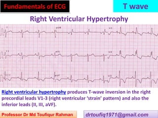 Approach to a patient with T wave abnormality in ECG | PPSX