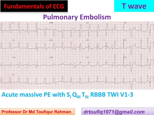 Approach to a patient with T wave abnormality in ECG | PPSX | Heart and Cardiovascular Diseases ...