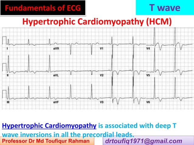 Approach To A Patient With T Wave Abnormality In Ecg Ppsx Heart And Cardiovascular Diseases