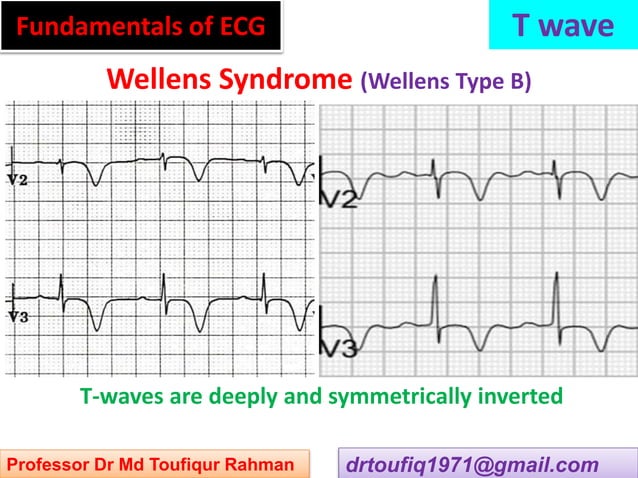 Approach to a patient with T wave abnormality in ECG | PPSX | Heart and ...