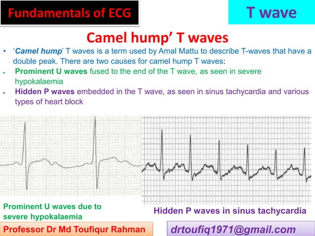 Approach to a patient with T wave abnormality in ECG | PPSX | Heart and ...