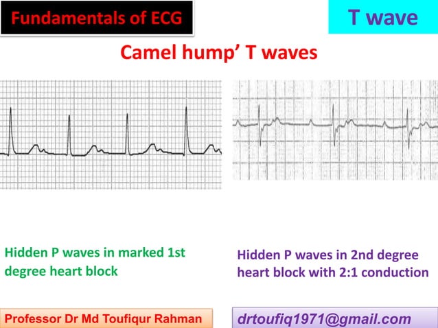 Approach to a patient with T wave abnormality in ECG | PPSX | Heart and ...
