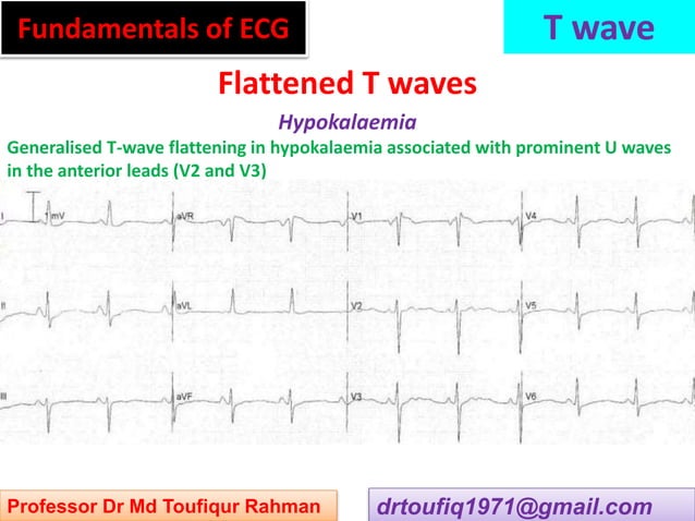Approach to a patient with T wave abnormality in ECG | PPSX | Heart and ...
