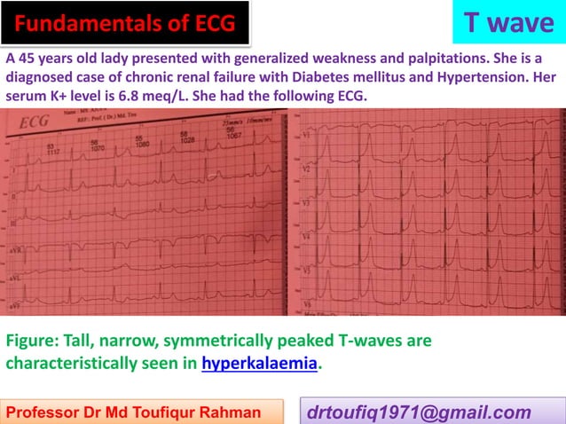 Approach to a patient with T wave abnormality in ECG | PPSX | Heart and Cardiovascular Diseases ...
