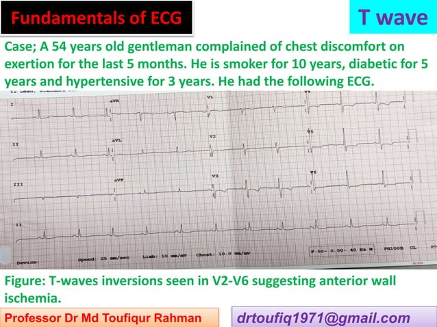 Approach to a patient with T wave abnormality in ECG | PPSX | Heart and ...
