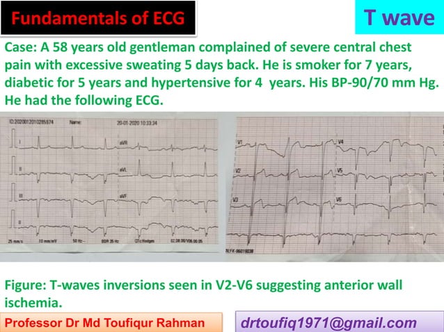 Approach to a patient with T wave abnormality in ECG | PPSX | Heart and ...
